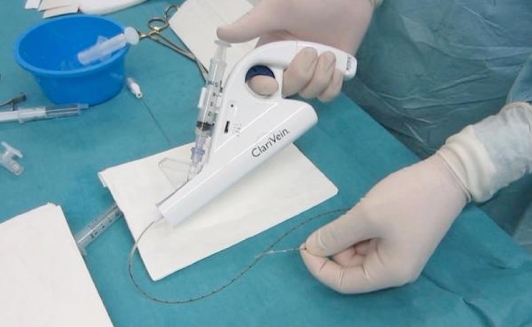 Tratamiento mínimamente invasivo de las varices mediante Clarivein-MOCA ...